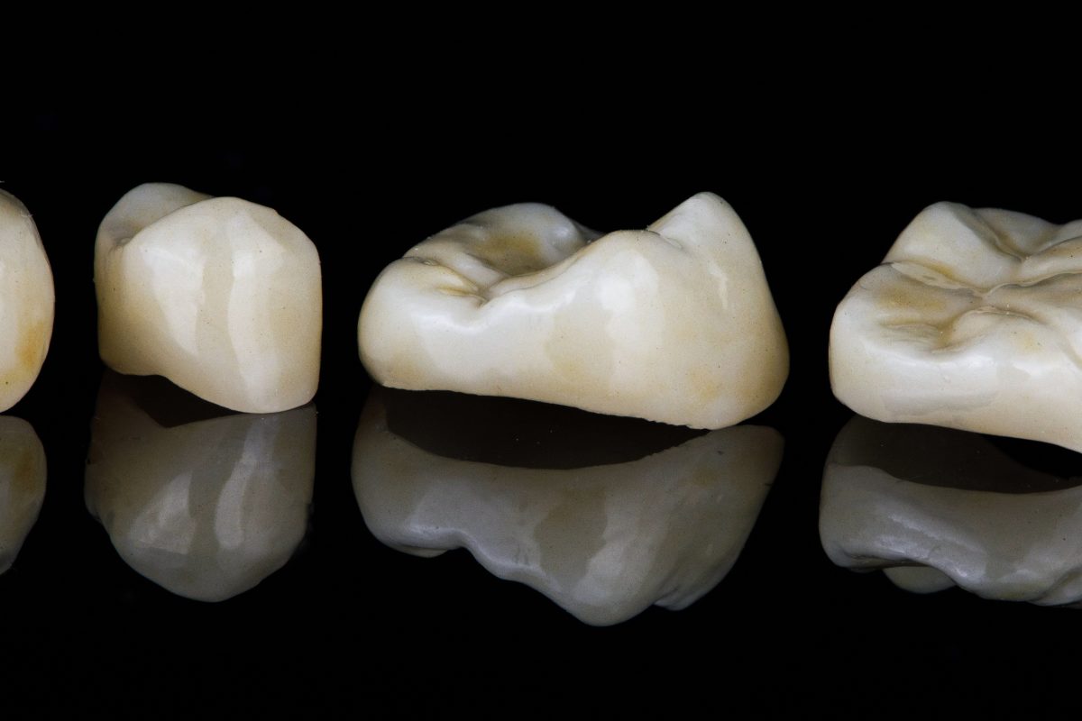 Restoring a Tooth With Inlays and Onlays